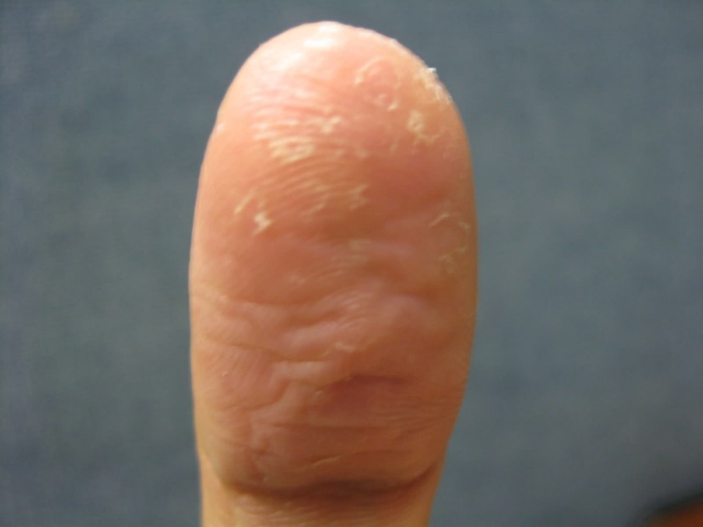 Top 10 Absolutely Effective Ways to Deal with Peeling Fingertips – Page ... Top 10 Absolutely Effective Ways to Deal with Peeling Fingertips – Page ...